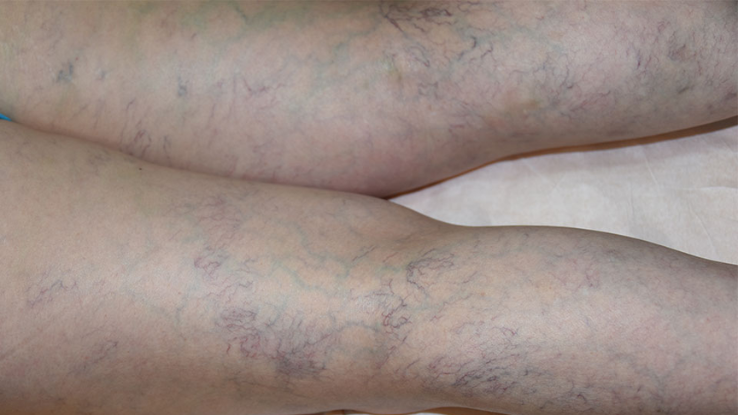 Varices: Estas son las causas, riesgos y lo que realmente pasa dentro ...